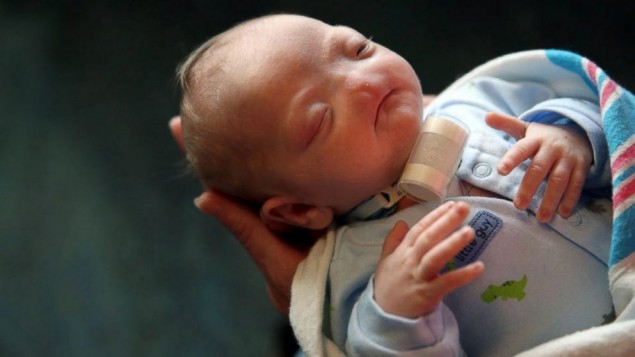 Meet Miracle Baby Born Without Nose And Breaths Perfectly (PHOTOS ...