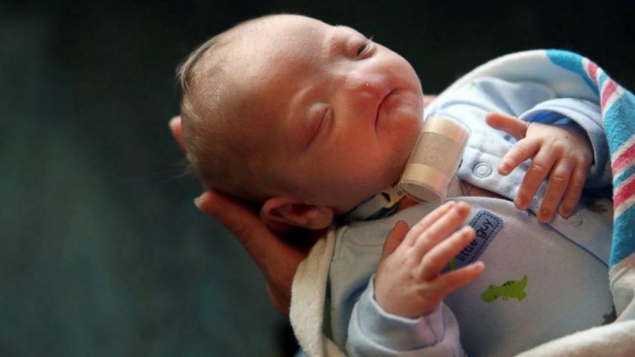 Meet Miracle Baby Born Without Nose And Breaths Perfectly (PHOTOS ...